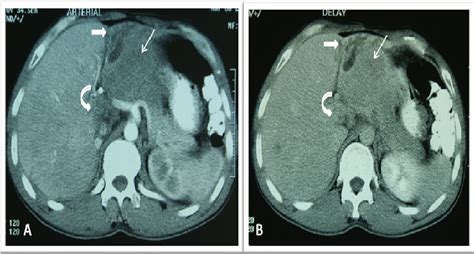 Abdominal Ct Scan With Iv And Oral Contrast A Arterial Phase B