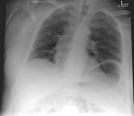 Malpositioned Nasogastric Tube Radiology Case Radiopaedia Org