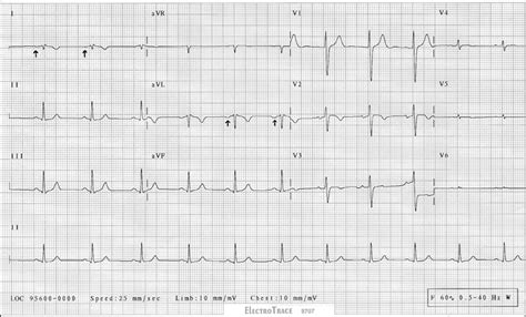 Dextrocardia