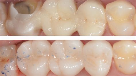 A Three Unit Bridge Restoration Of A Fractured Ceramic Crown