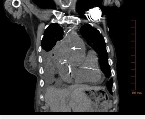 Arrow Showing Large Peri Aortic Hematoma Formation In The Setting Of Download Scientific