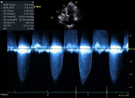 Continuous Wave Doppler Interrogation Of Aortic Valve Demonstrating