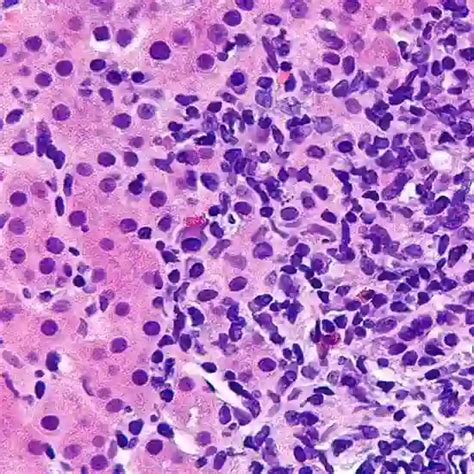 Autoimmune Liver Disease Profile 1 Test In Delhi Ncr India Gdic