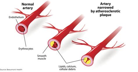 Coronary Calcium Scan Manhattan Cardiology Manhattan Ny