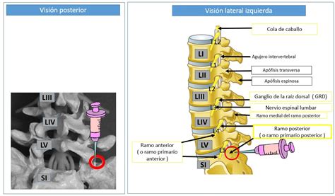 Bloqueo Del Ramo Posterior Del Nervio Espinal Lumbar L5 Dolopedia