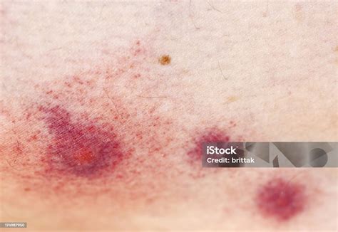 Mosquito Bites Pictures Allergic Reaction