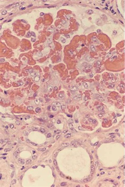 Nephrology Thrombotic Microangiopathy Haemolyticuraemic Syndrome Pmc
