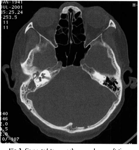 Tuberculous Otitis Media Semantic Scholar