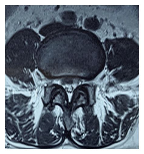 A Representative Case Of Olif Surgery With Radiographs And Mri Scan