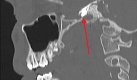 Neurolytic Blocks Anesthesia Key