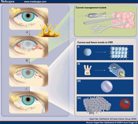 Ocular Surface Reconstruction Recent Innovations Post Op Management