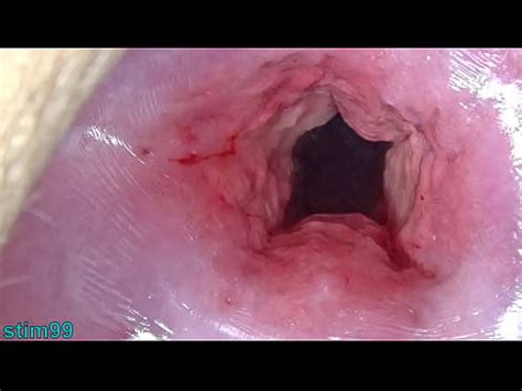 Uncensored Japanese Cervix Stretching And Uterus Dilation With Penetration XVIDEOS
