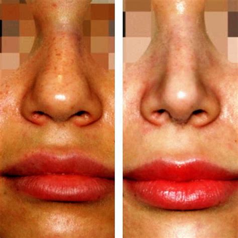 Open Rhinoplasty Nose Tip Surgery Rhinoplasty Cost Pics Reviews Qanda