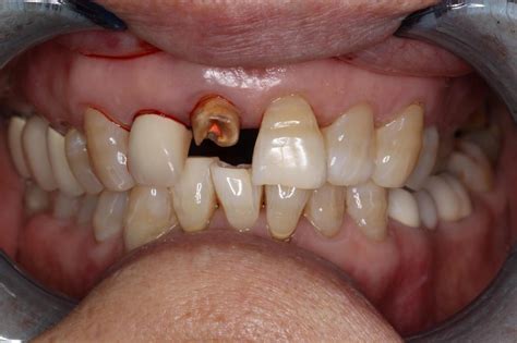 Root Canal Before And After
