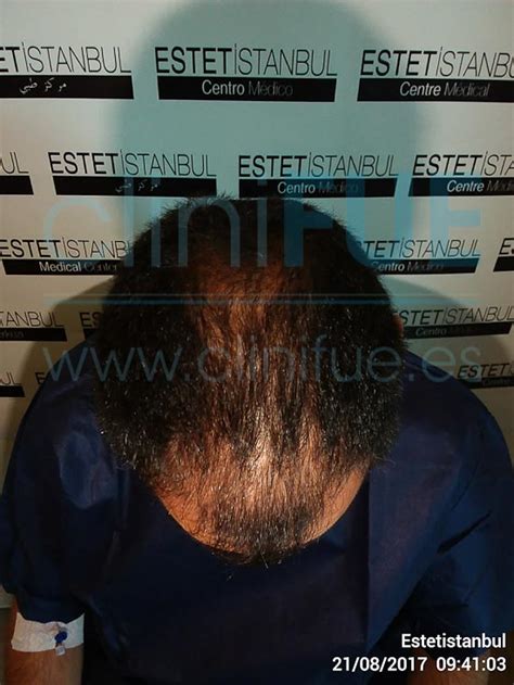 Trasplante capilar de Jose 30 Años de Murcia con cliniFUE cliniFUE