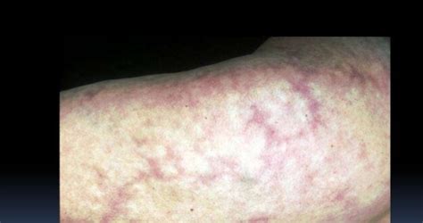 Livedo Reticularis Mottling Skin Causes Pictures Treatment