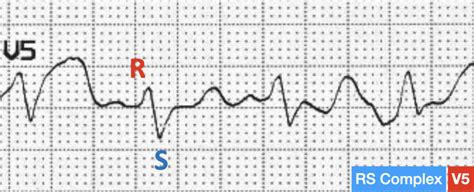 Left Bundle Branch Block Lbbb • Litfl • Ecg Library Diagnosis
