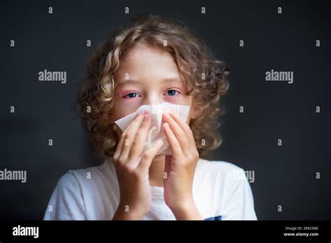 Pink Eye Symptoms Runny Nose At Evelyn Mcelroy Blog