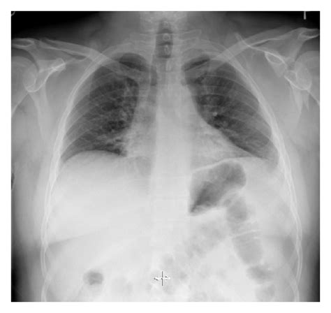 Anteroposterior Chest Radiograph Demonstrating A Left Scapular Fracture Download Scientific