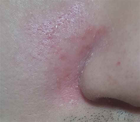 코 옆 광대뼈 사이 건조 지식in