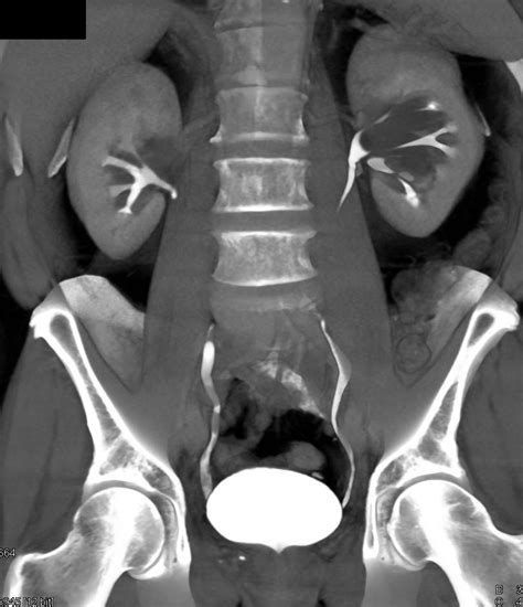 Hydronephrosis X Ray