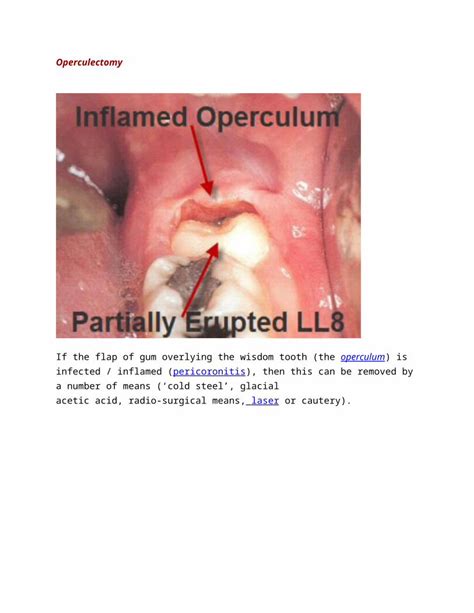 Docx Operculectomy Dokumentips
