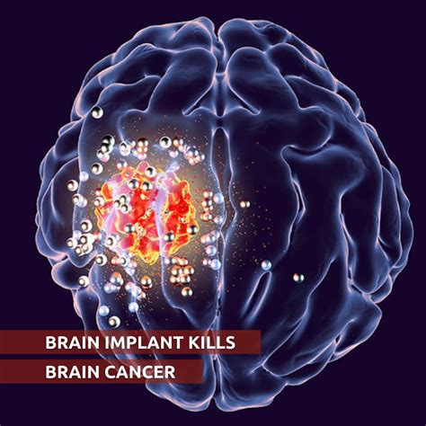 Dianox On Linkedin Medical Braincancer Cancerresearch Implant