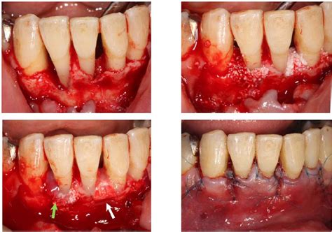 Surgical Procedures A Debridement Of Intrabony Defect B