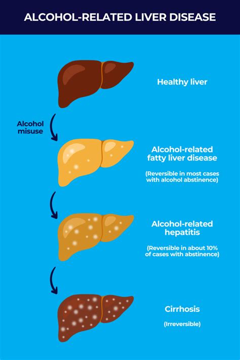 Liver Cirrhosis Alcohol