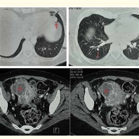 Thoracoabdominopelvic Ct Scan Showing A Large Right Latero Uterine