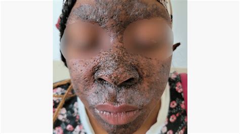 Cellulitis Symptoms Causes Prognosis Treatment