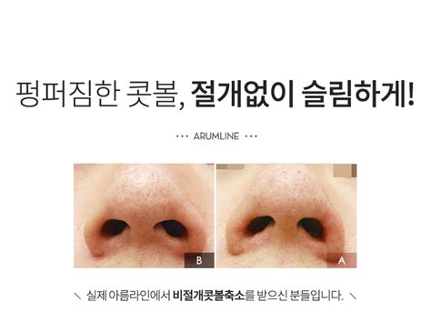 콧볼축소 비절개 미세콧볼축소 쌍커풀 자연유착 비절개뒤트임 눈꼬리올림 트임재수술 윗트임 이마거상 미니거상