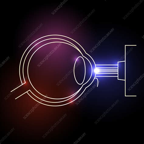 Laser Eye Surgery Illustration Stock Image F043 8011 Science Photo Library