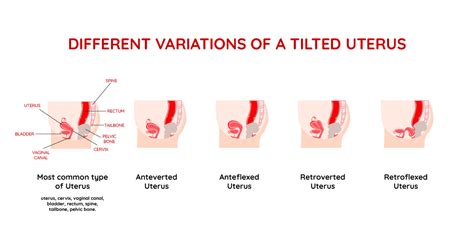 Retroverted Uterus Cervix Position
