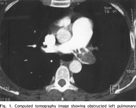 Figure 1 From Surgical Treatment Of Right Atrial Myxoma Complicated