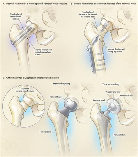 Management Of Acute Hip Fracture Nejm Surgery Nursing Hip Surgery