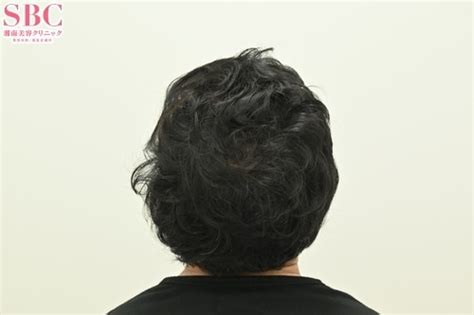【症例写真】頭頂部にaga治療とジェットメソで更なるボリュームを！｜湘南agaクリニックの薄毛治療・自毛植毛