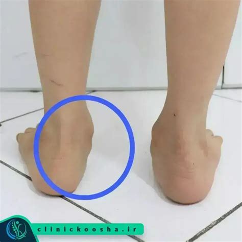 آیا کف پای صاف ارثی است؟ همراه با ویدئو و عکس