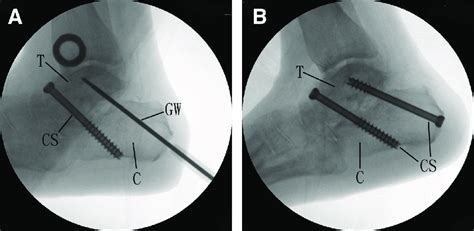 Endoscopic Revision Subtalar Arthrodesis Of The Left Foot The Patient