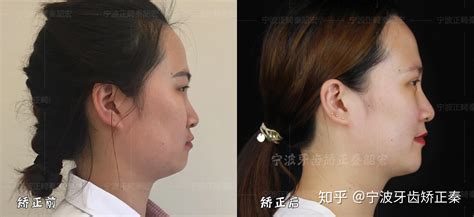 下巴后缩怎么办解决方法看这里 知乎