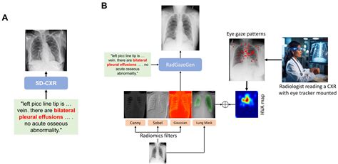 논문 리뷰 Radgazegen Radiomics And Gaze Guided Medical Image Generation Using Diffusion Models