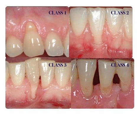 Classification Of Gingival Recession Dental Desk Academy