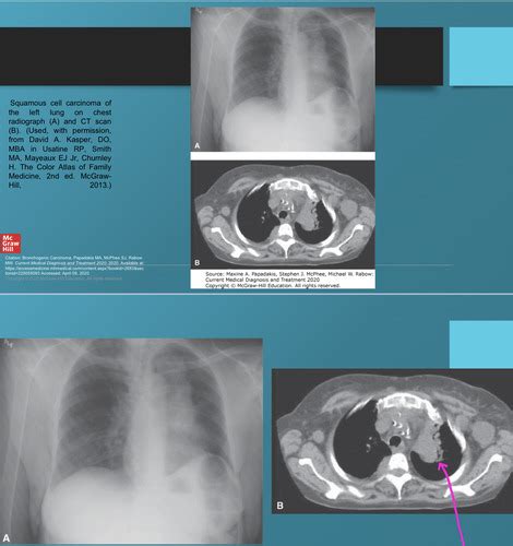 Bronchogenic Carcinoma Flashcards Quizlet