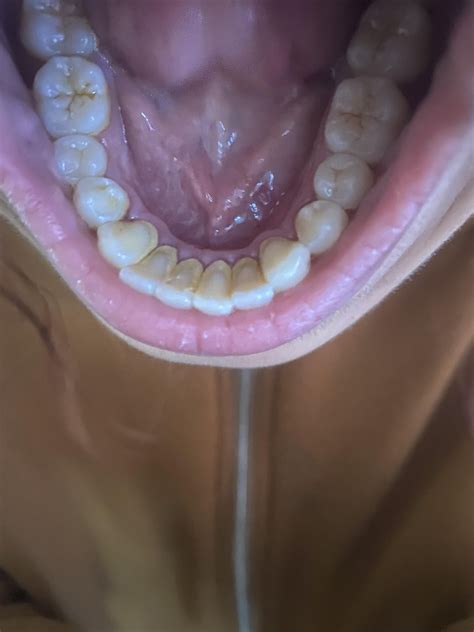 My 8 Bottom Front Teeth Started Bleeding Badly Especially 3 Front Ones I Started Flossing And