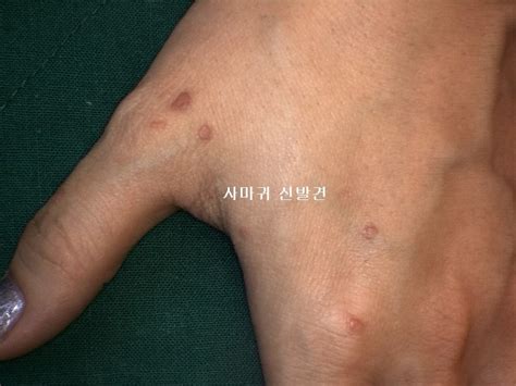 손에 사마귀 없애는 방법은
