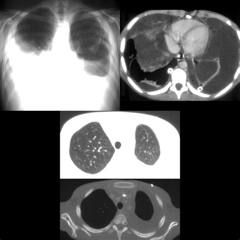 Tuberous Sclerosis Pediatric Radiology Reference Article Pediatric