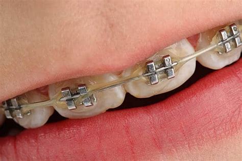 Understanding Braces Brackets What You Need To Know
