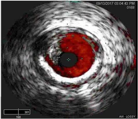 Ivus Demonstrating Artery Dissection Seen On Coronary Angiography