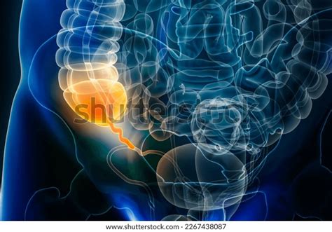 Appendicitis Disease Vermiform Appendix Inflammation 3d Stock