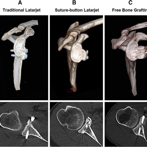 Graft Glenoid Interface Healing Axial And En Face Views At 1 Year Download Scientific Diagram
